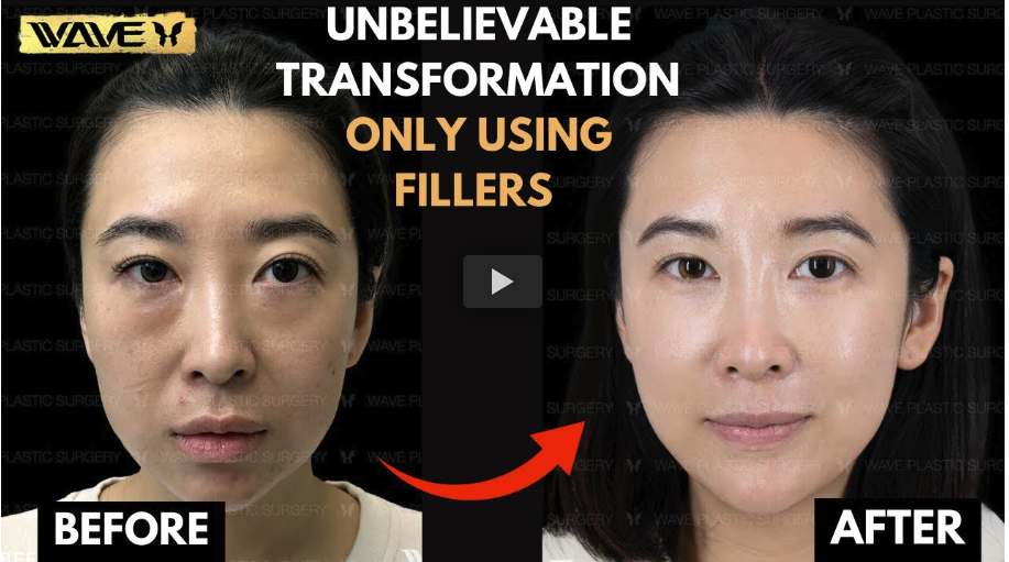 Pyramid Rejuvenation by Dr. Peter Lee | Wave Plastic Surgery